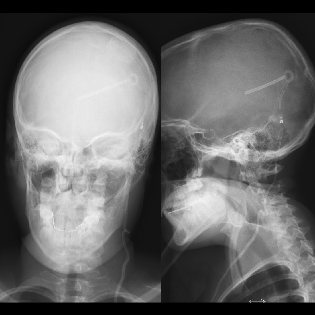 Pediatric Ventriculoperitoneal Shunt Malfunction / Malposition ...