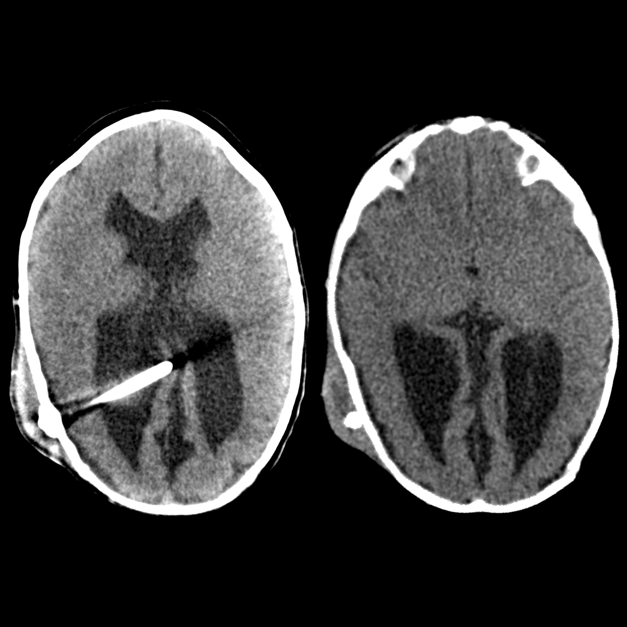Pediatric Ventriculoperitoneal Shunt Malfunction / Malposition ...