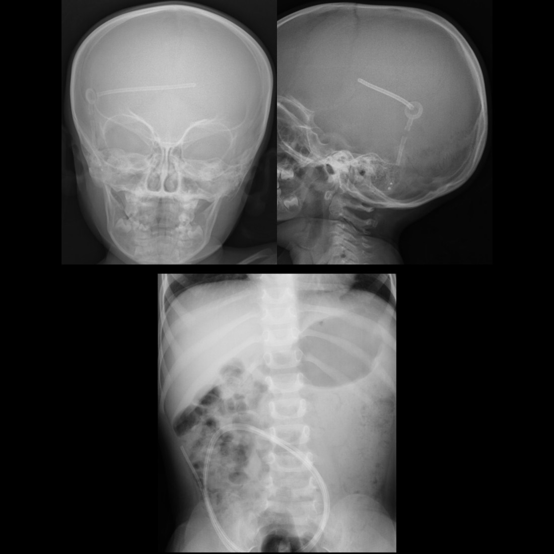 Pediatric Ventriculoperitoneal Shunt Malfunction / Malposition ...