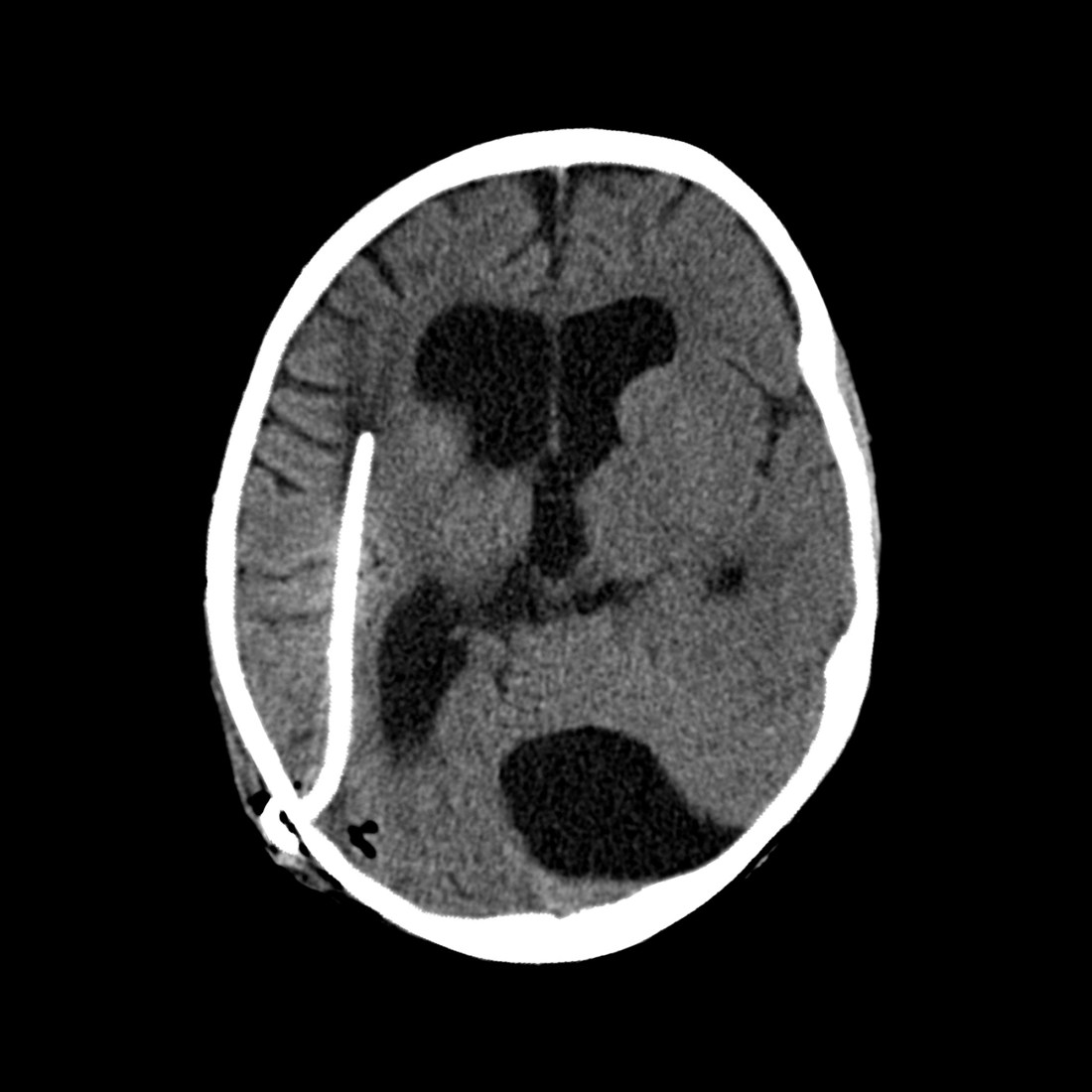 Pediatric Ventriculoperitoneal Shunt Malfunction / Malposition ...