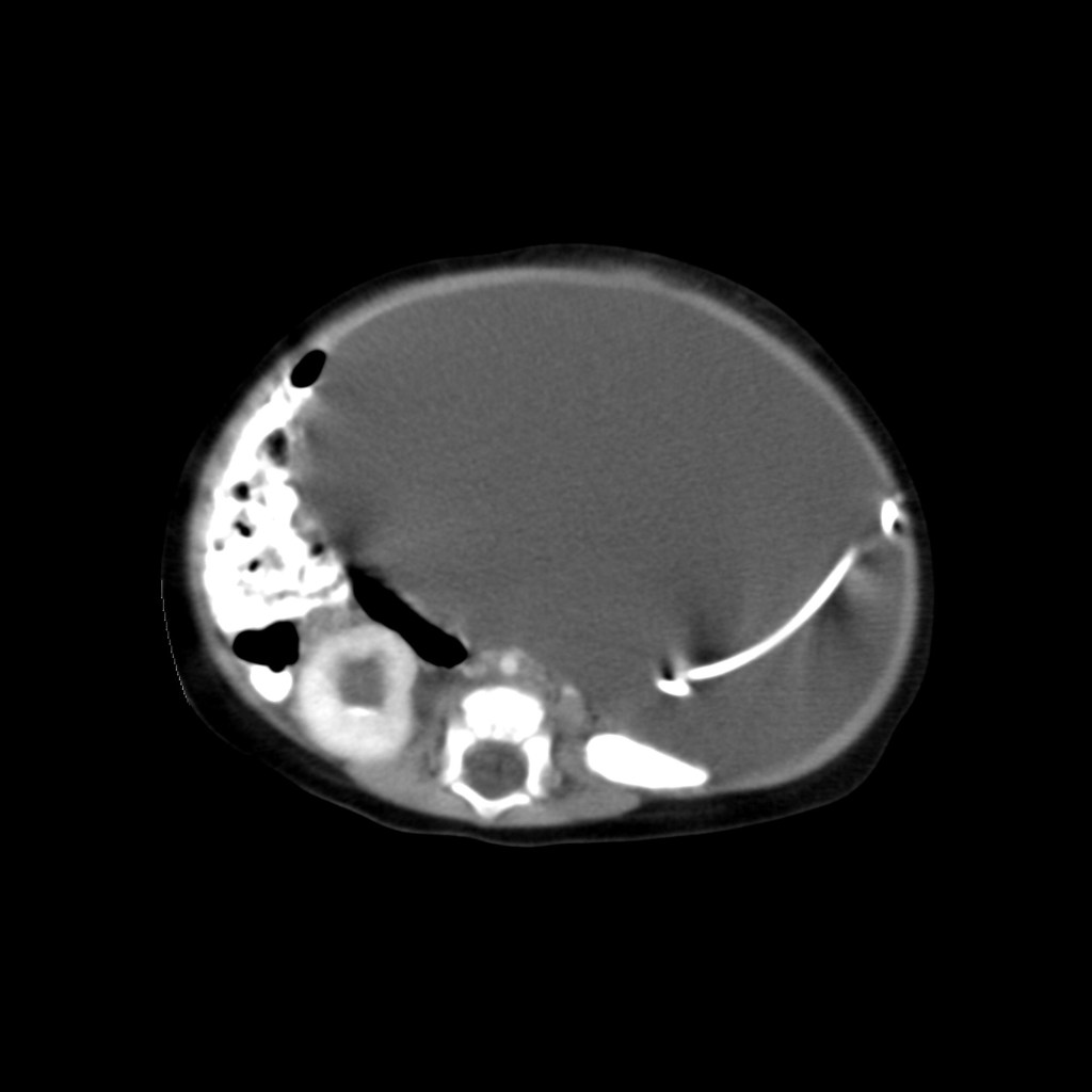 Pediatric Ventriculoperitoneal Shunt Malfunction / Malposition ...