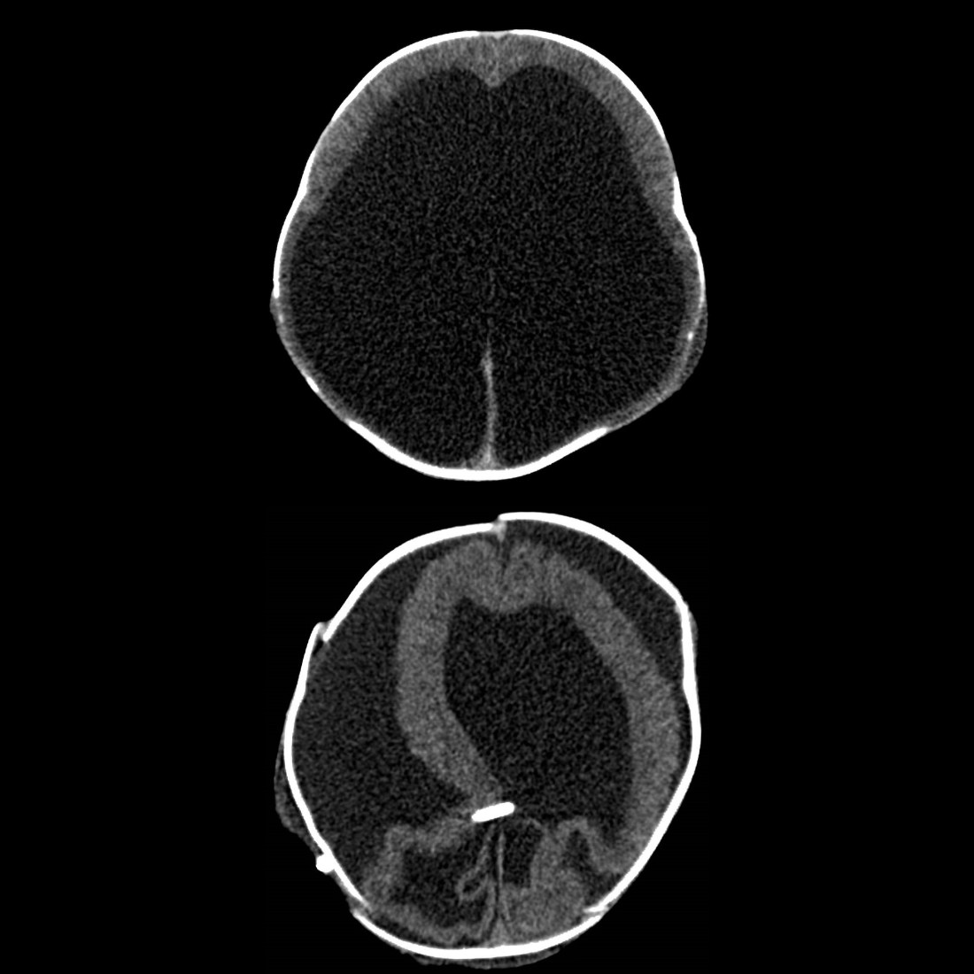 Pediatric Ventriculoperitoneal Shunt Malfunction / Malposition ...