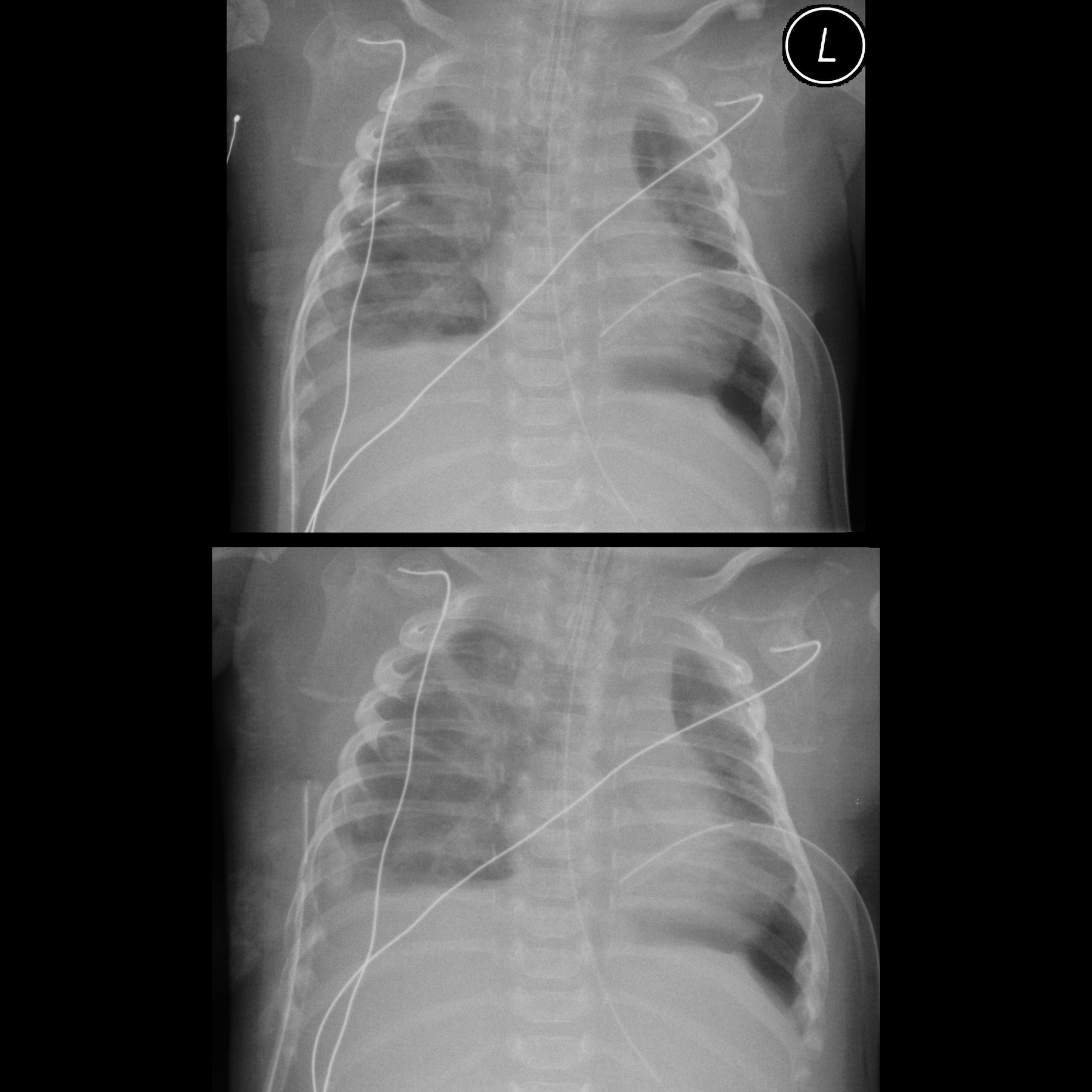 Infant whose right chest tube has stopped draining pleural fluid ...