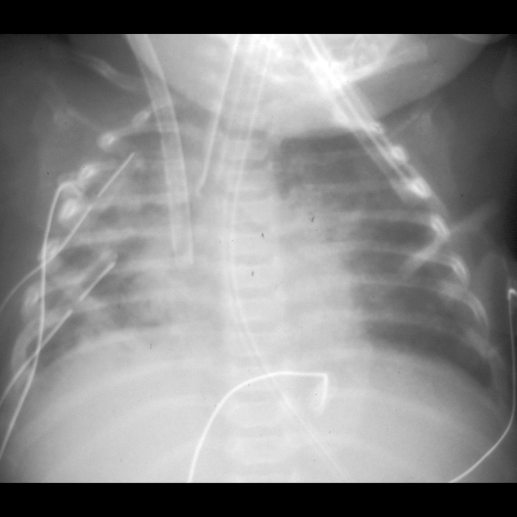 Pediatric Extracorporeal Membrane Oxygenation | Pediatric Radiology ...