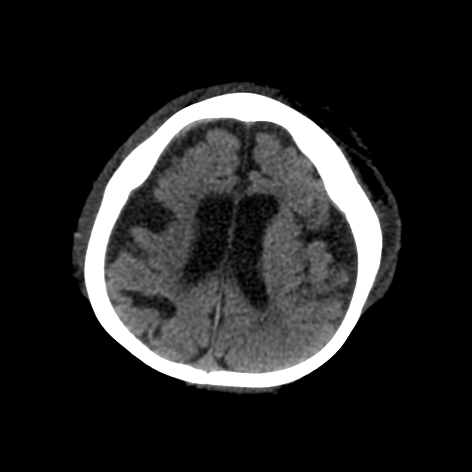 Pediatric Cerebral Atrophy | Pediatric Radiology Reference Article ...