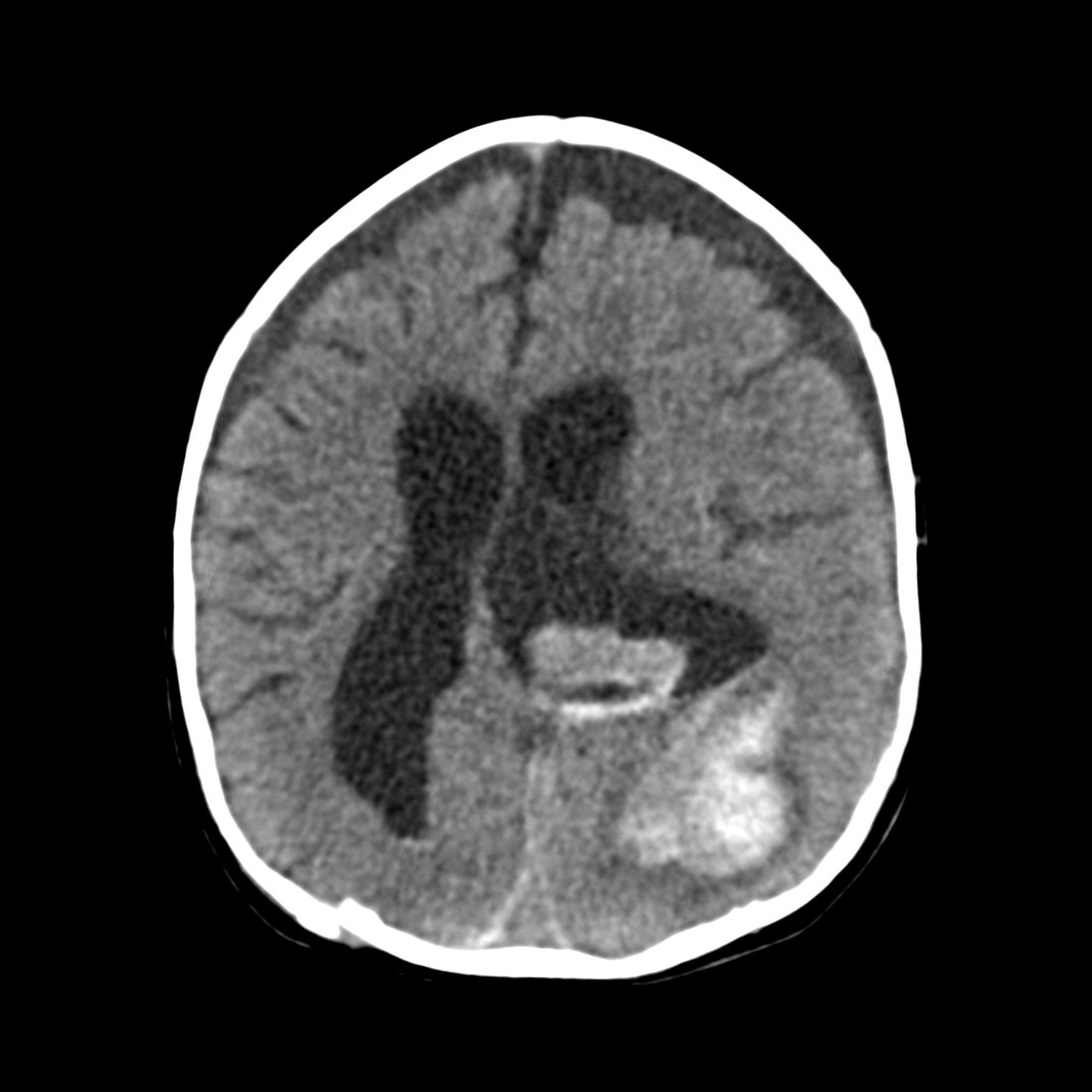 Non-Neonatal Intraventricular Hemorrhage | Pediatric Radiology ...