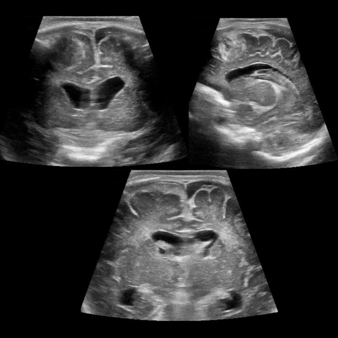 Pediatric Subdural Hematoma | Pediatric Radiology Reference Article ...