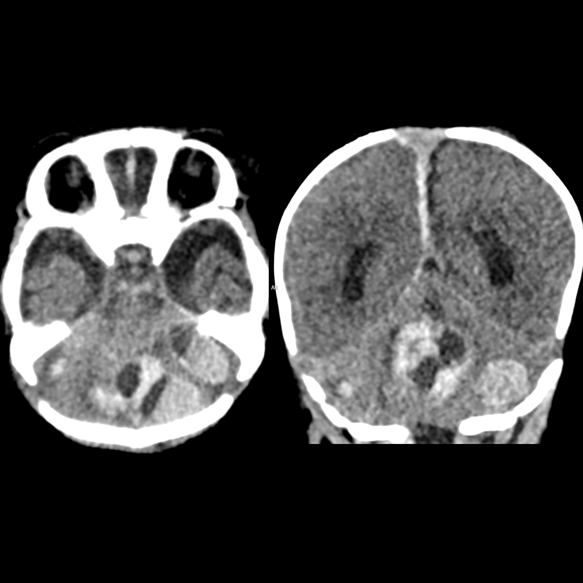 Pediatric Cerebellar Hemorrhage | Pediatric Radiology Reference Article ...