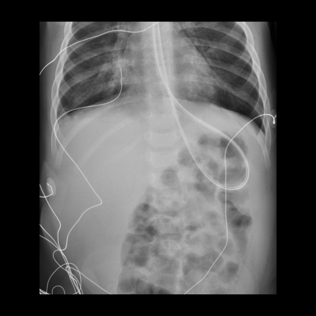 Pediatric Feeding Tube Malfunction / Malposition / Misposition ...