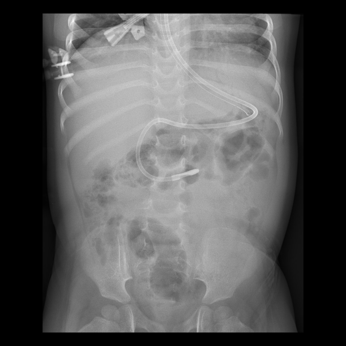 Toddler after feeding tube placement | Pediatric Radiology Case ...