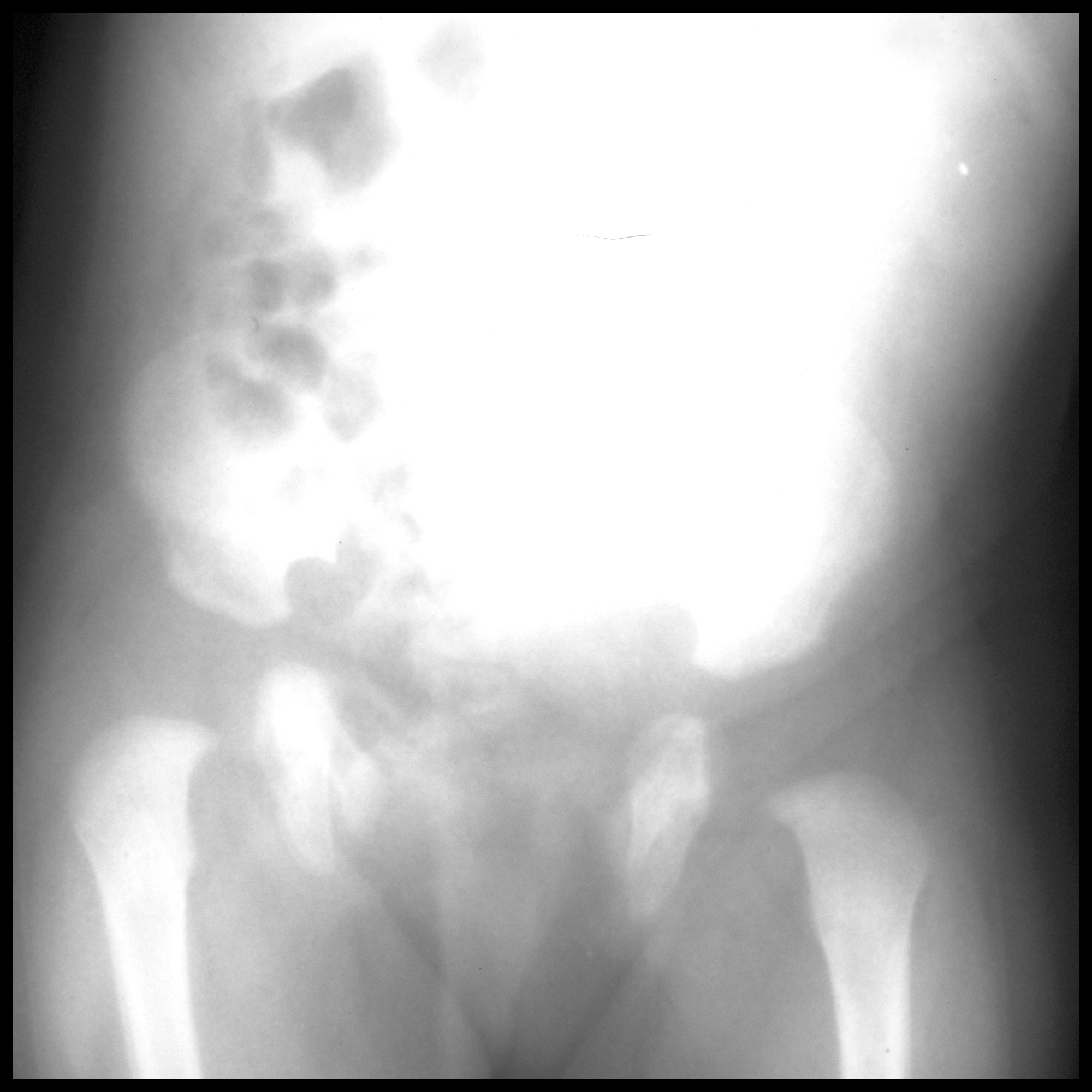 Bladder Exstrophy | Pediatric Radiology Reference Article | Pediatric ...