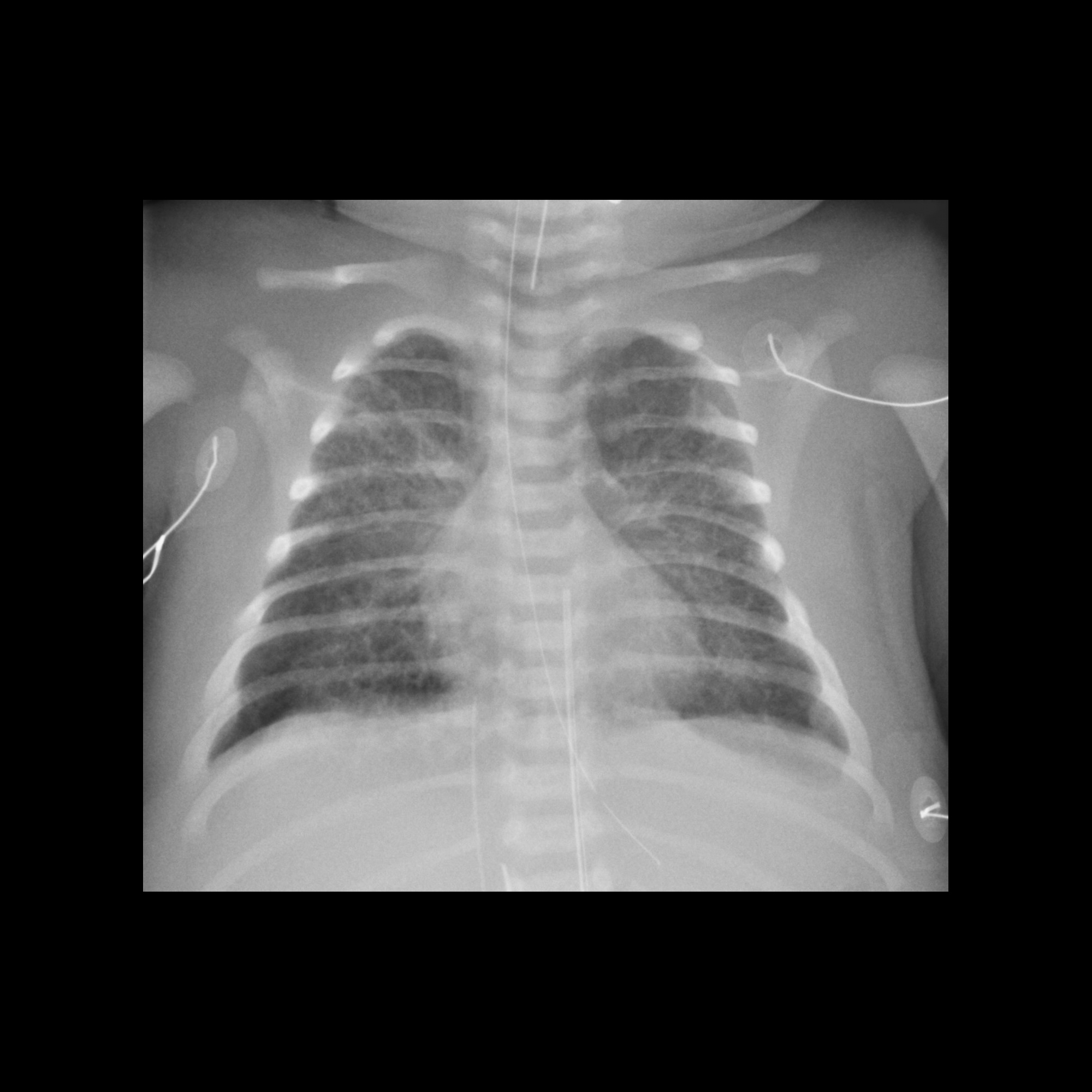 Pediatric Endotracheal Tube Malfunction / Malposition / Misposition ...