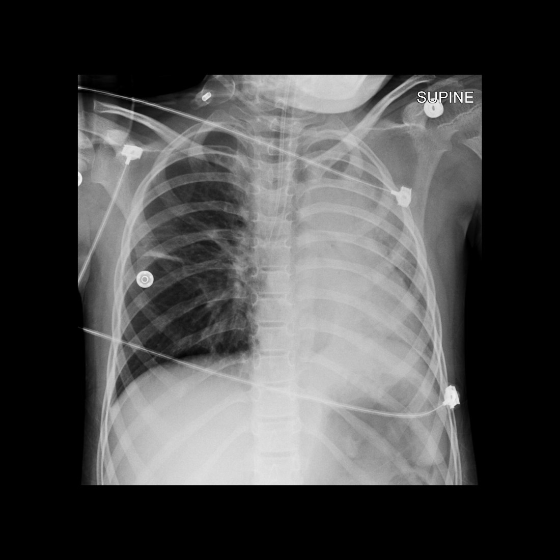 Pediatric Endotracheal Tube Malfunction / Malposition / Misposition ...