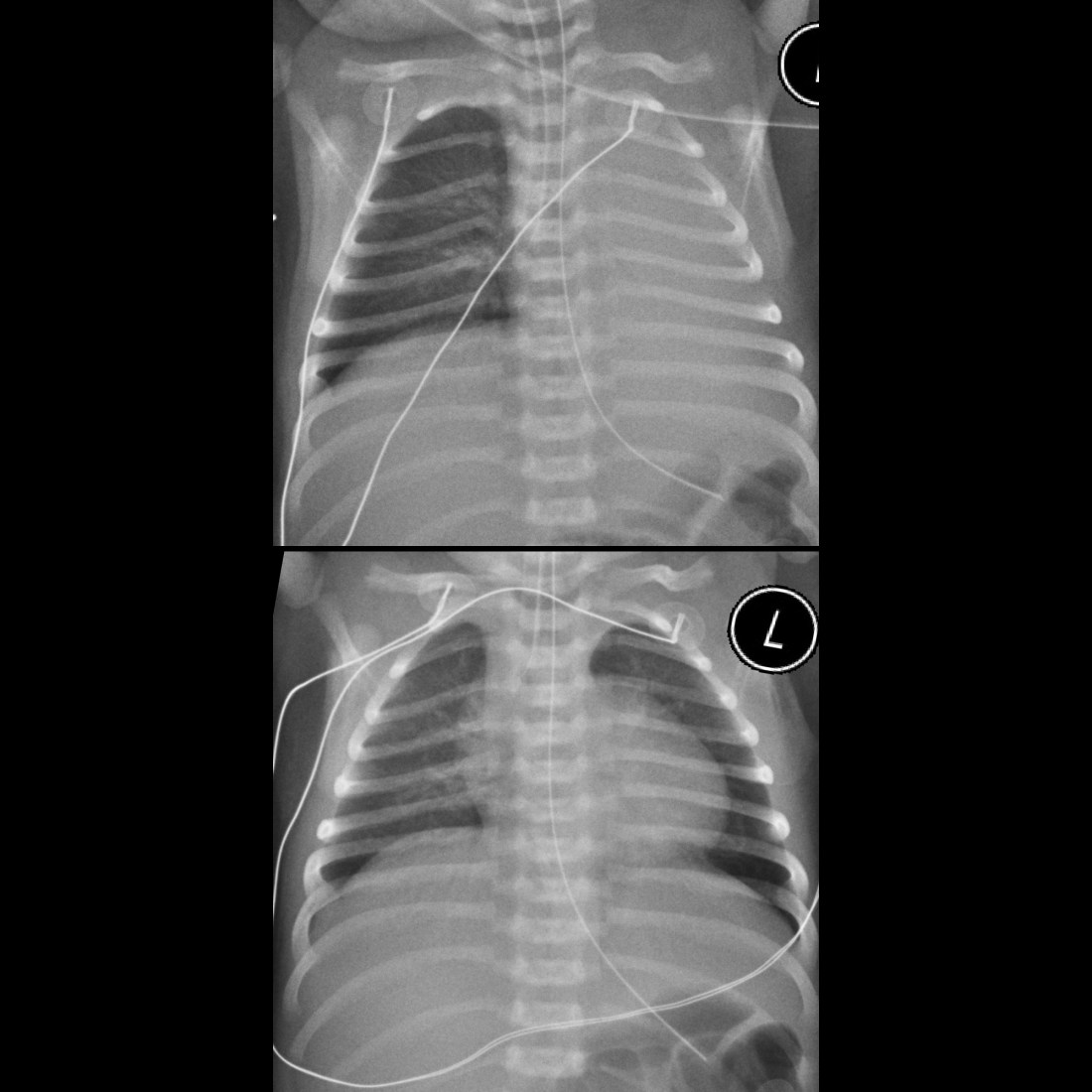 Pediatric Endotracheal Tube Malfunction / Malposition / Misposition ...