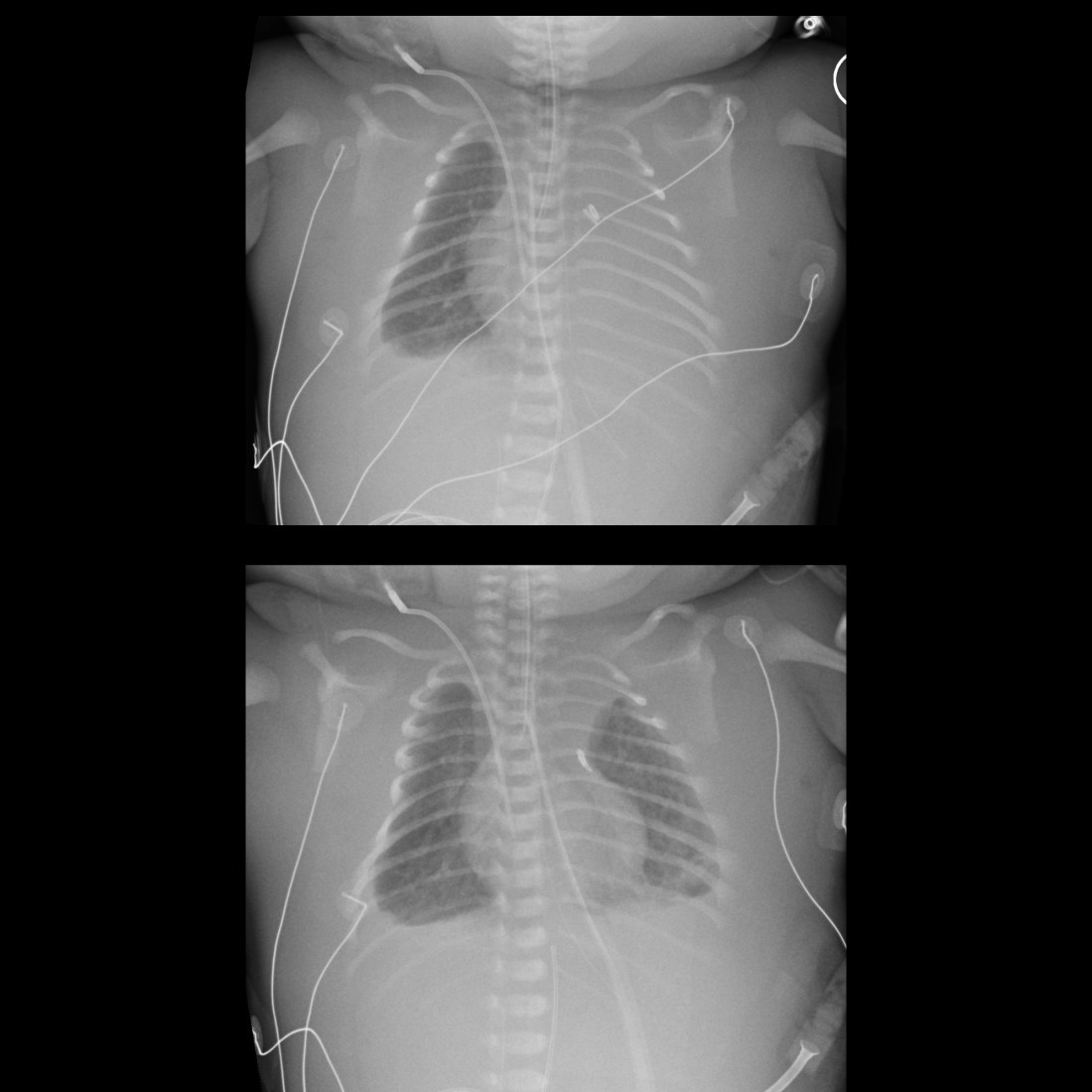 Pediatric Endotracheal Tube Malfunction / Malposition / Misposition ...