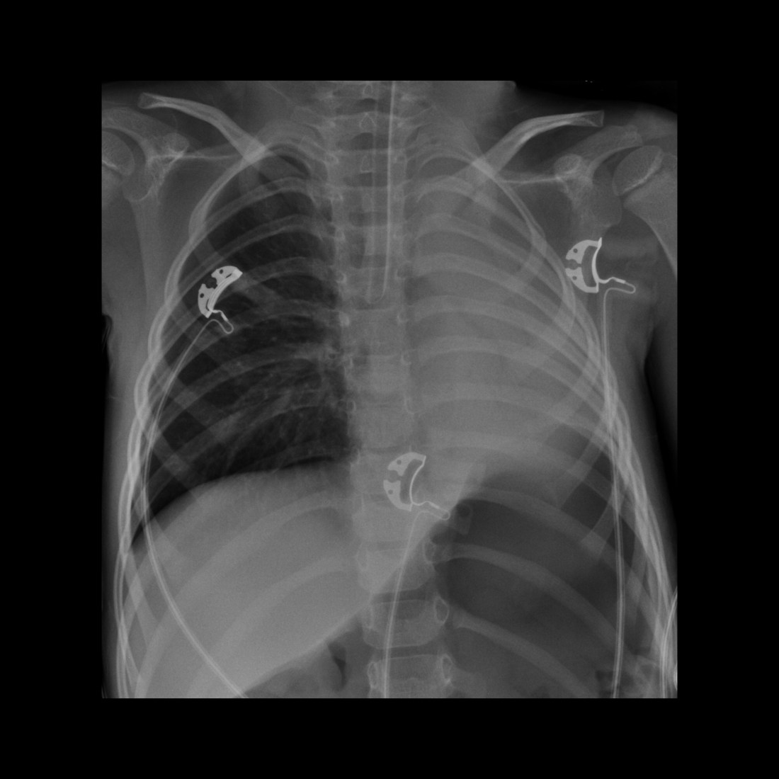 Pediatric Endotracheal Tube Malfunction / Malposition / Misposition ...