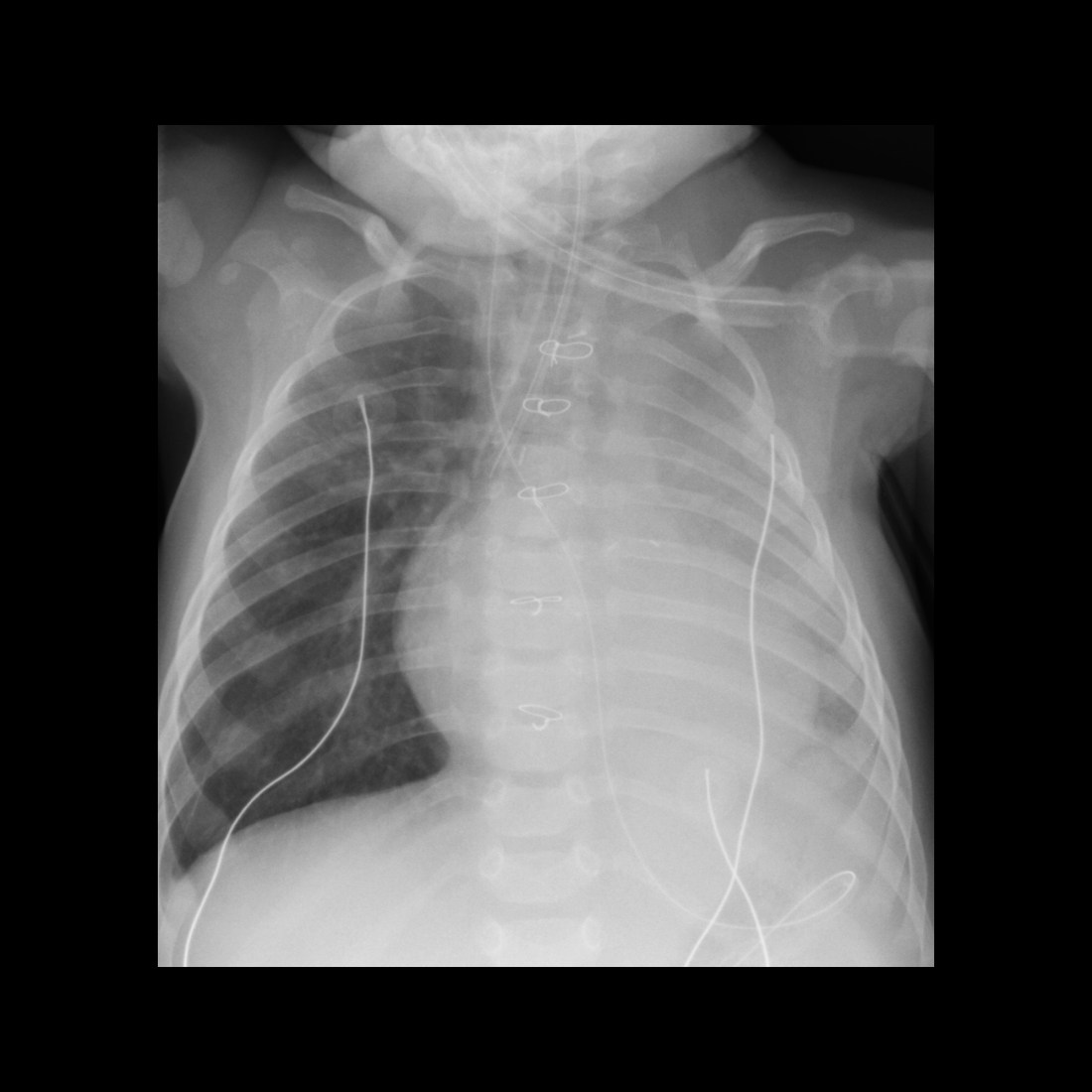 Pediatric Endotracheal Tube Malfunction / Malposition / Misposition ...