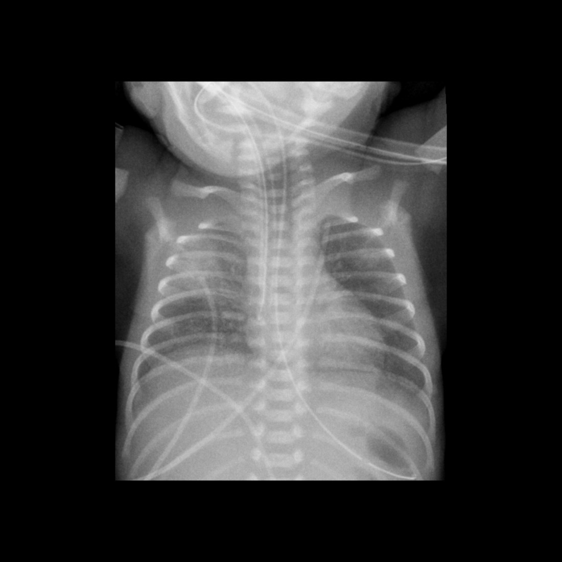 Respiratory Distress Syndrome | Pediatric Radiology Reference Article ...