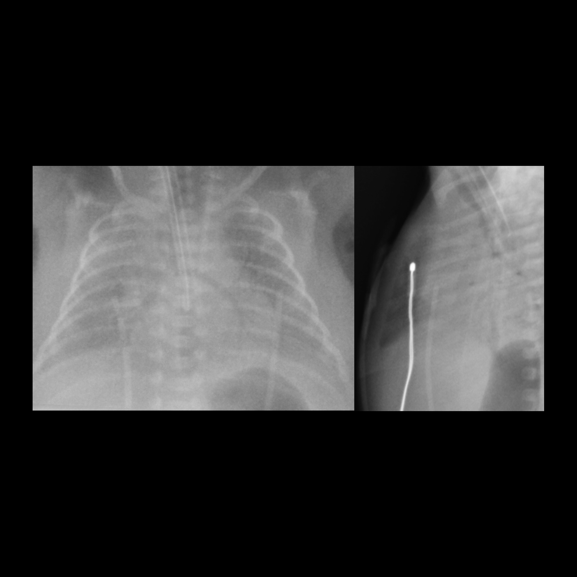 Pediatric Endotracheal Tube Malfunction / Malposition / Misposition ...