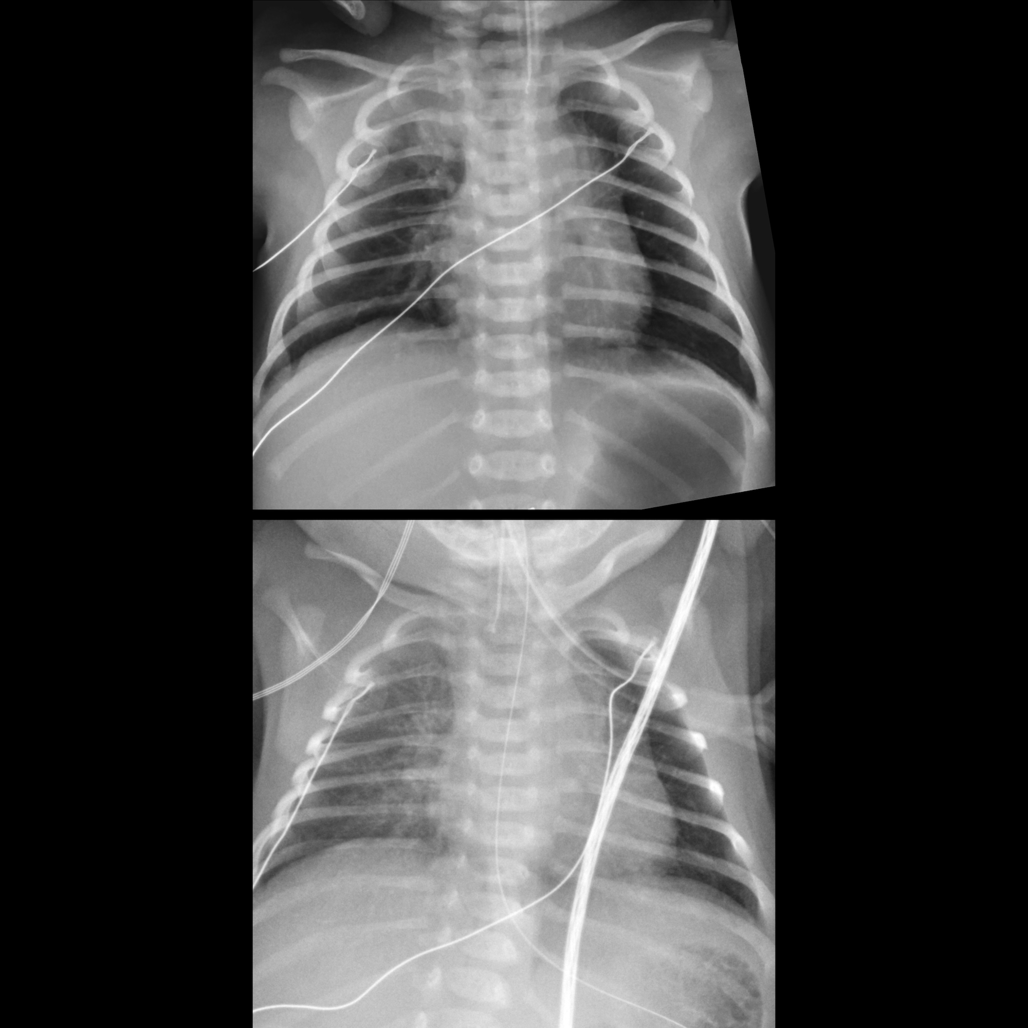 Pediatric Endotracheal Tube Malfunction / Malposition / Misposition ...