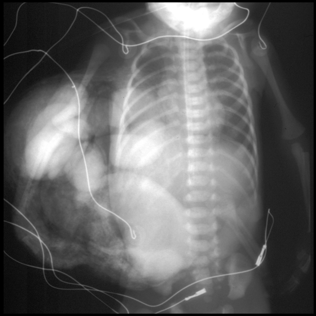 Newborn with an anterior abdominal wall defect diagnosed on prenatal US ...