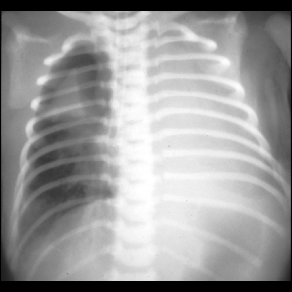Premature newborn with worsening respiratory distress after intubation ...