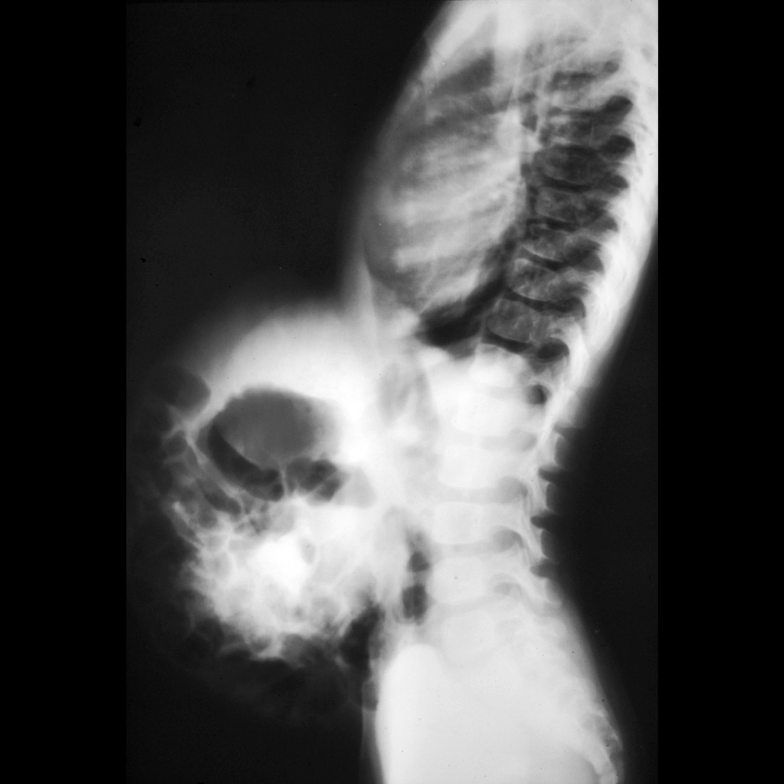 Omphalocele | Pediatric Radiology Reference Article | Pediatric Imaging ...