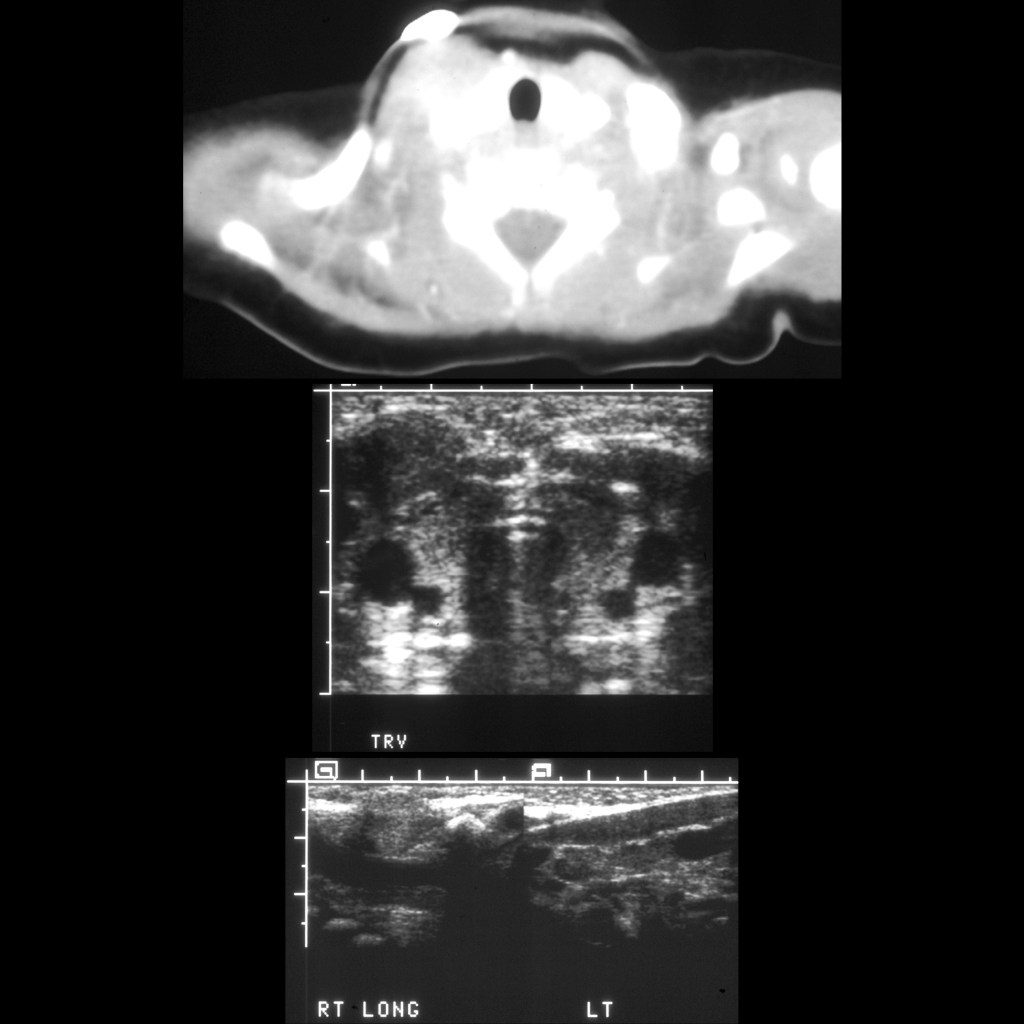 Fibromatosis Colli Fibromatosis Colli In Bamako: An Entity To Know In
