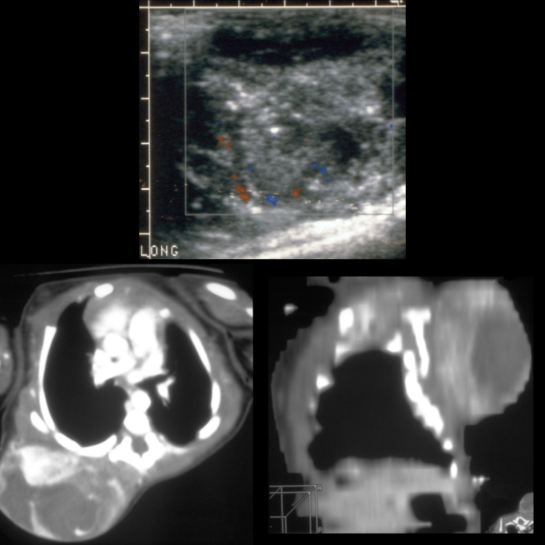 Newborn with a large soft tissue mass on their back | Pediatric ...