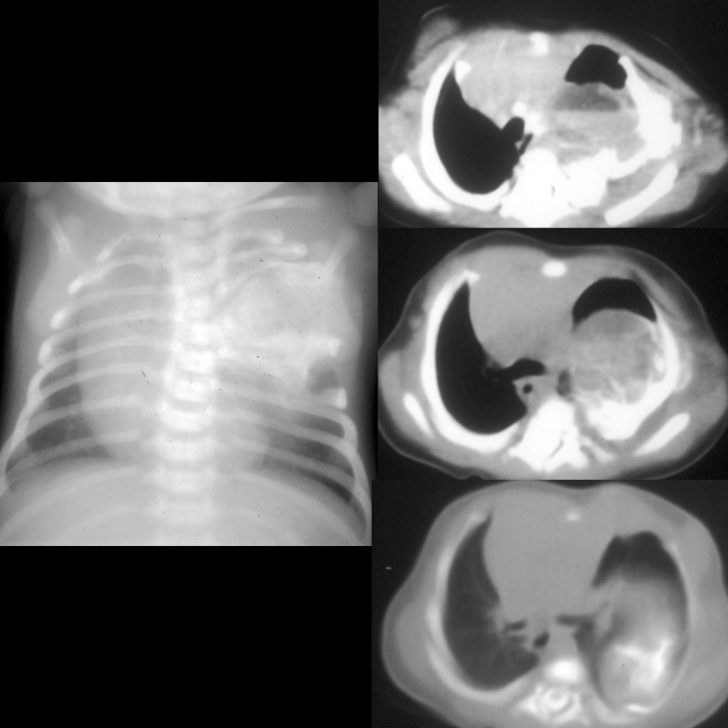 Newborn with a large left chest wall deformity | Pediatric Radiology ...