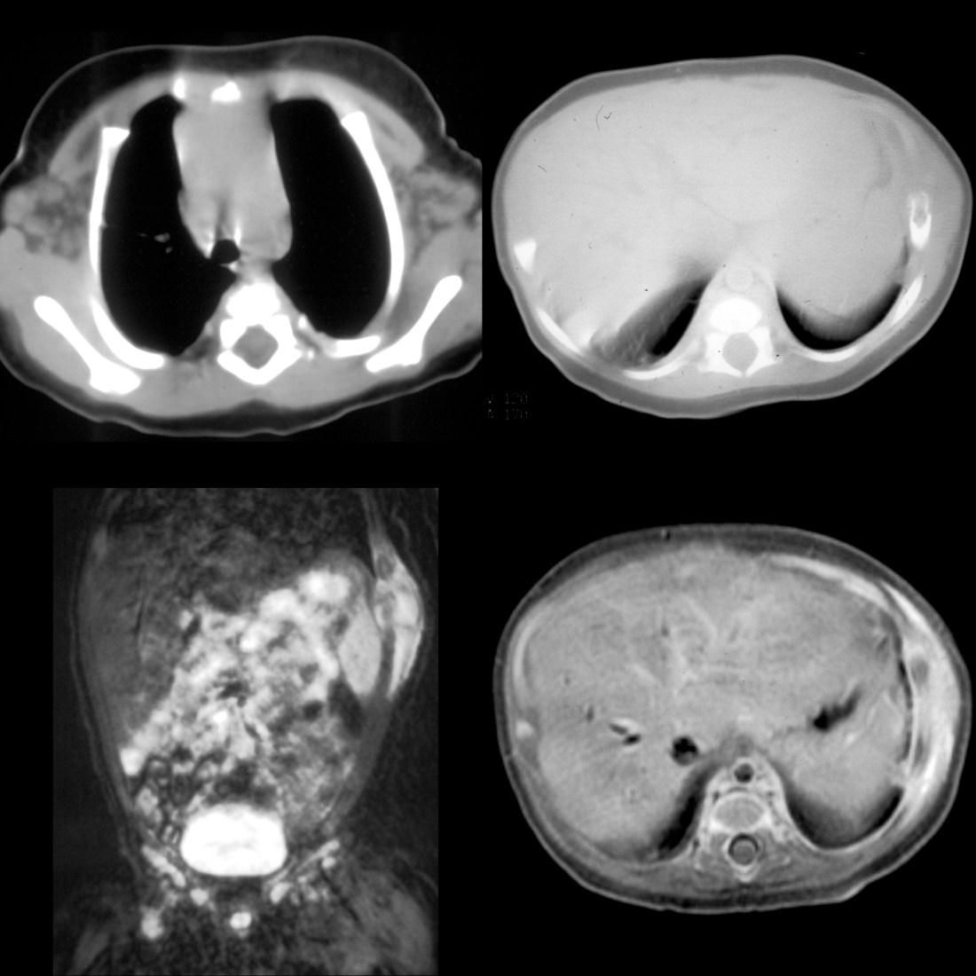 Pediatric Cellulitis | Pediatric Radiology Reference Article ...