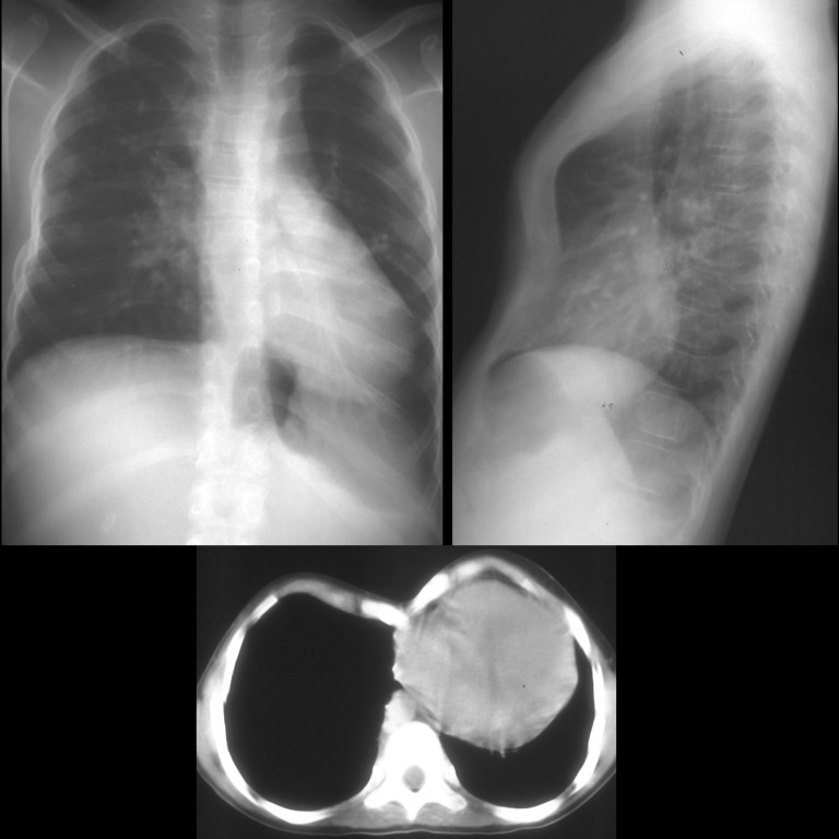Pectus Excavatum | Pediatric Radiology Reference Article | Pediatric ...