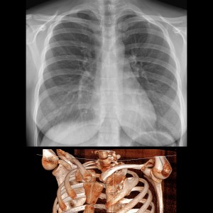 Pediatric Rib Fusion | Pediatric Radiology Reference Article ...