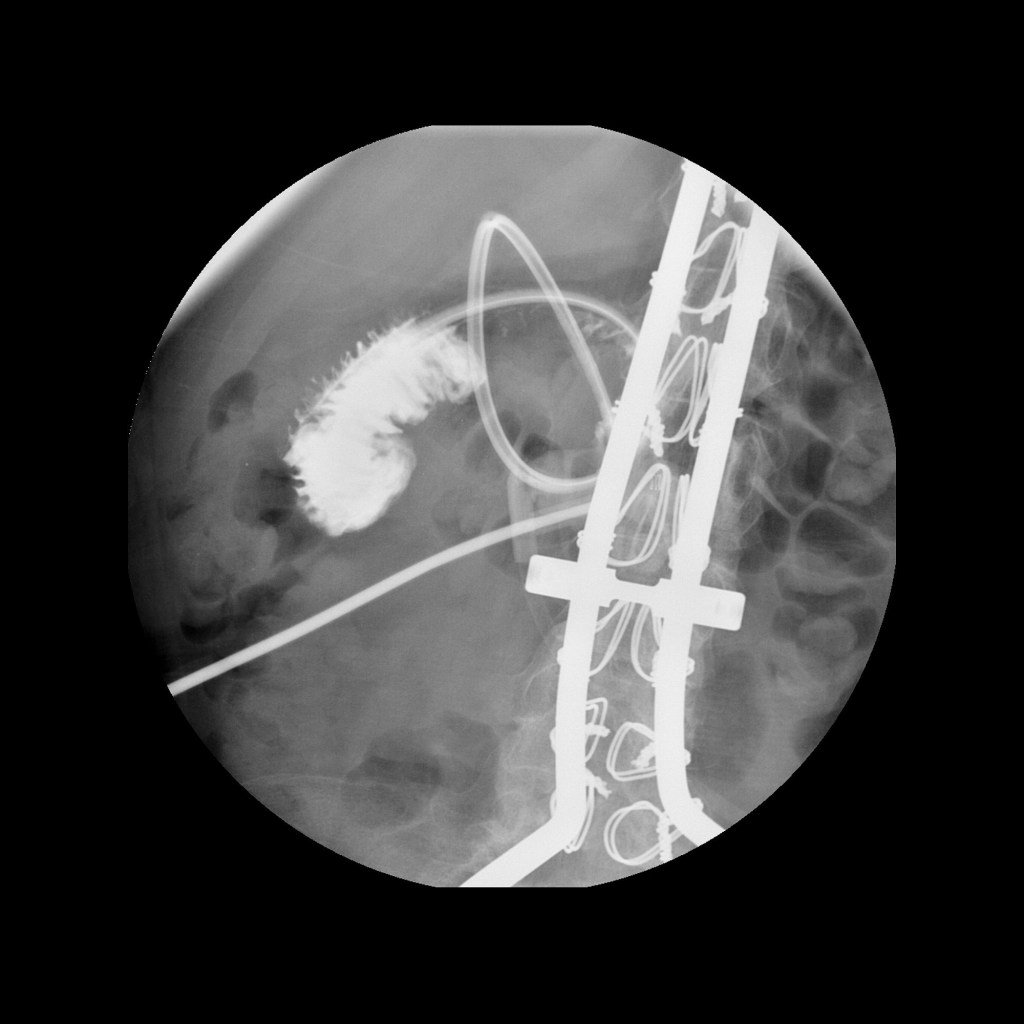 Pediatric Gastrojejunostomy Tube Malfunction / Malposition ...