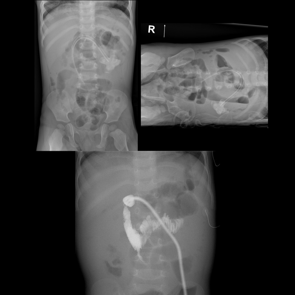 Pediatric Gastrojejunostomy Tube Malfunction / Malposition ...