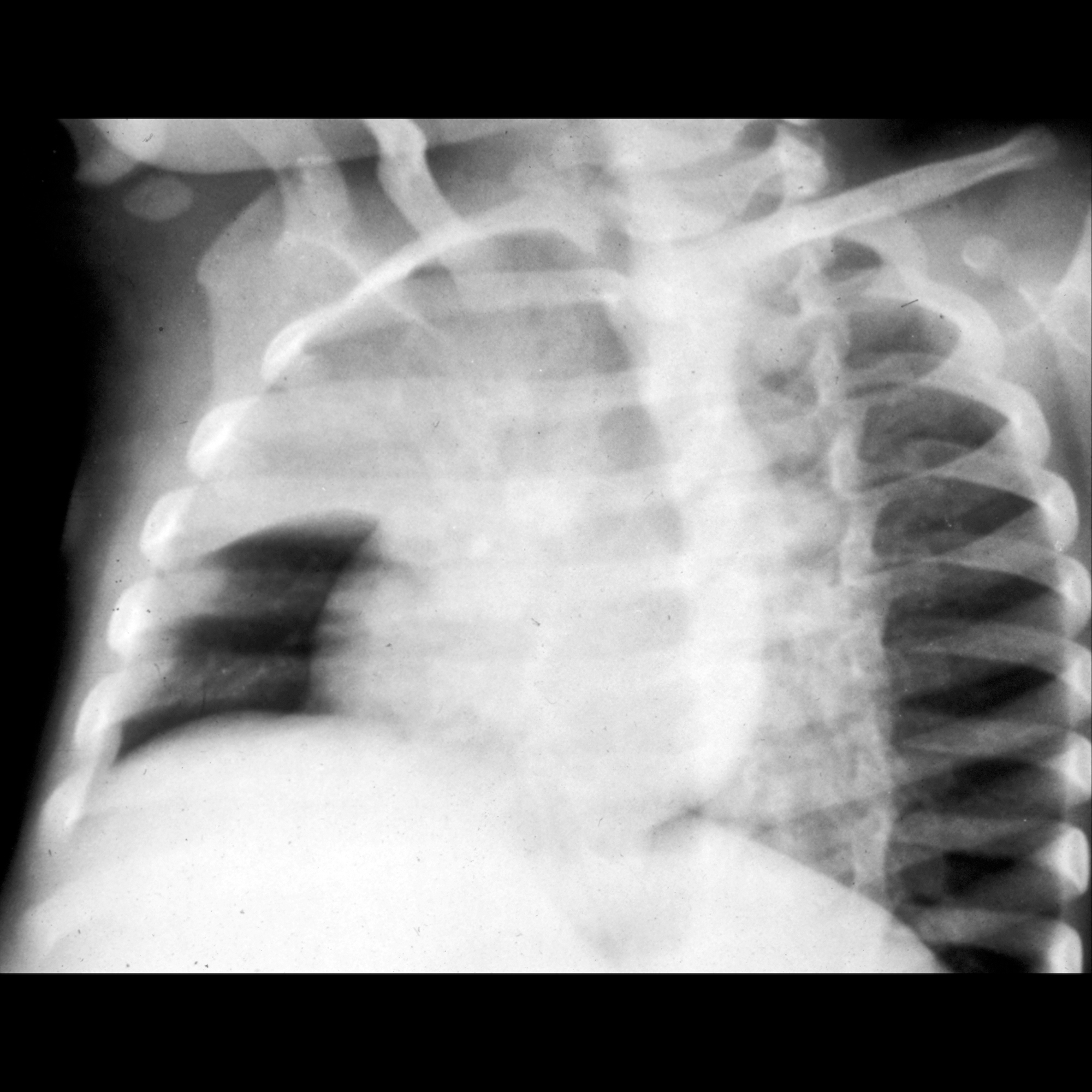 Normal Thymus | Pediatric Radiology Reference Article | Pediatric ...