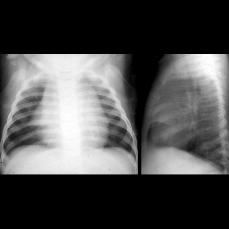 Normal Thymus | Pediatric Radiology Reference Article | Pediatric ...