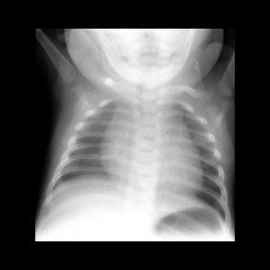 Normal Thymus | Pediatric Radiology Reference Article | Pediatric ...