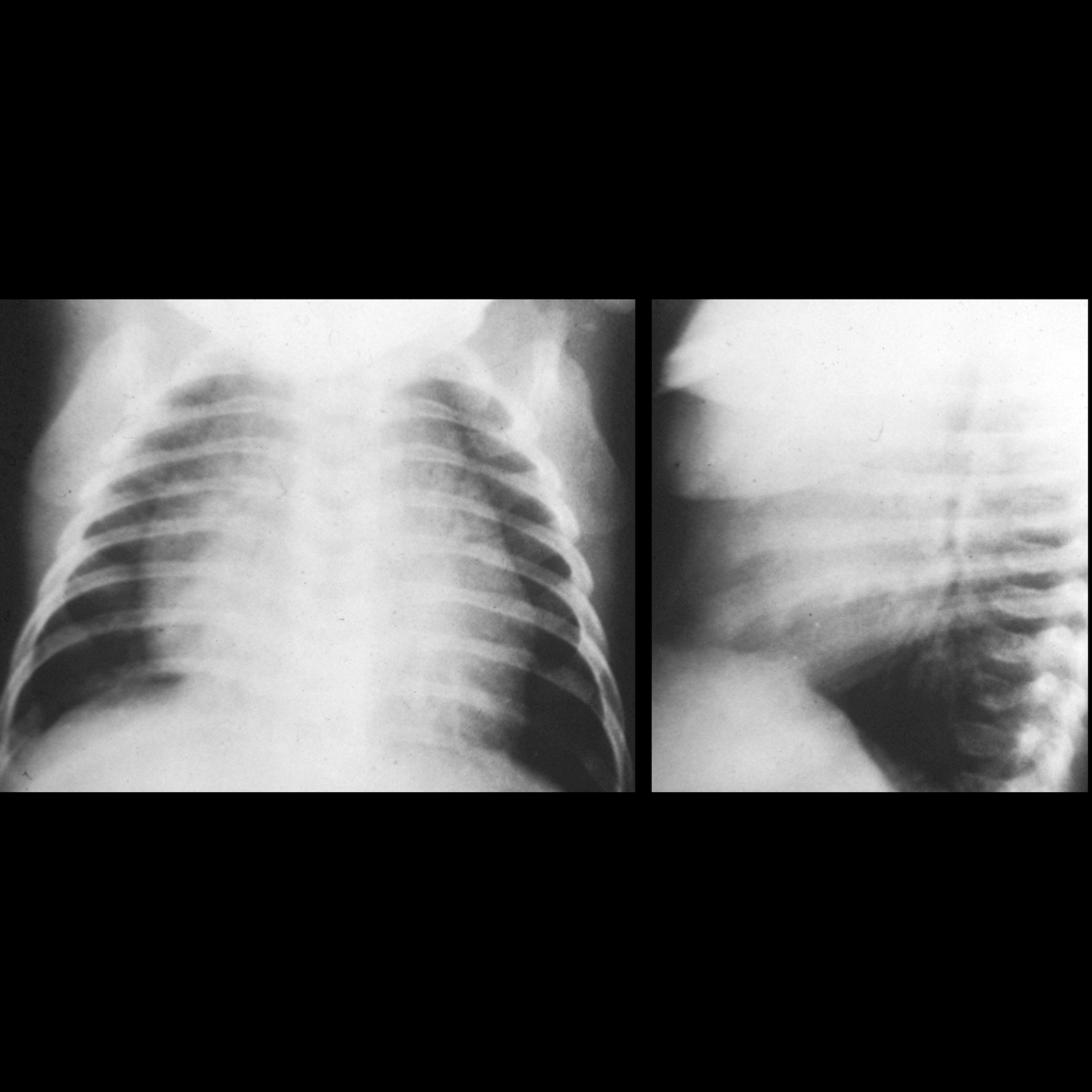 Prominent Thymus | Pediatric Radiology Reference Article | Pediatric ...
