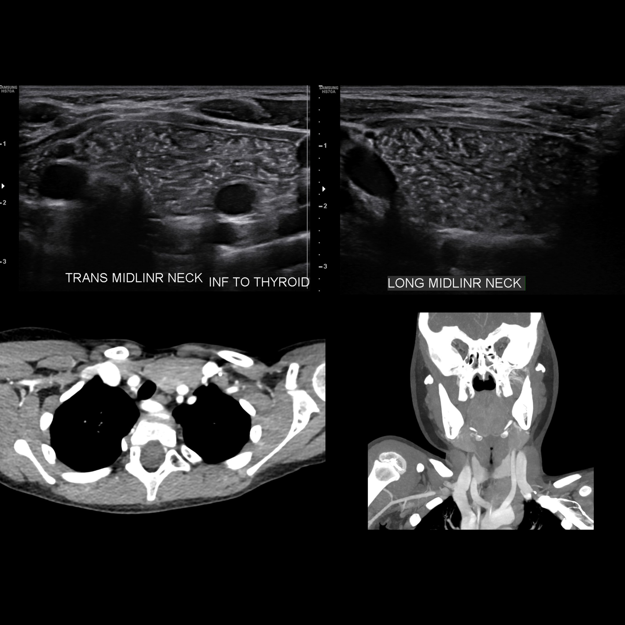 Normal Thymus | Pediatric Radiology Reference Article | Pediatric ...