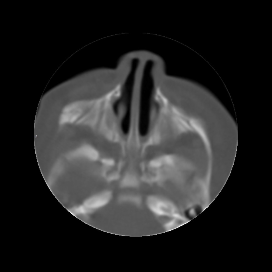 Newborn with inability to pass a nasogastric tube through either nares ...