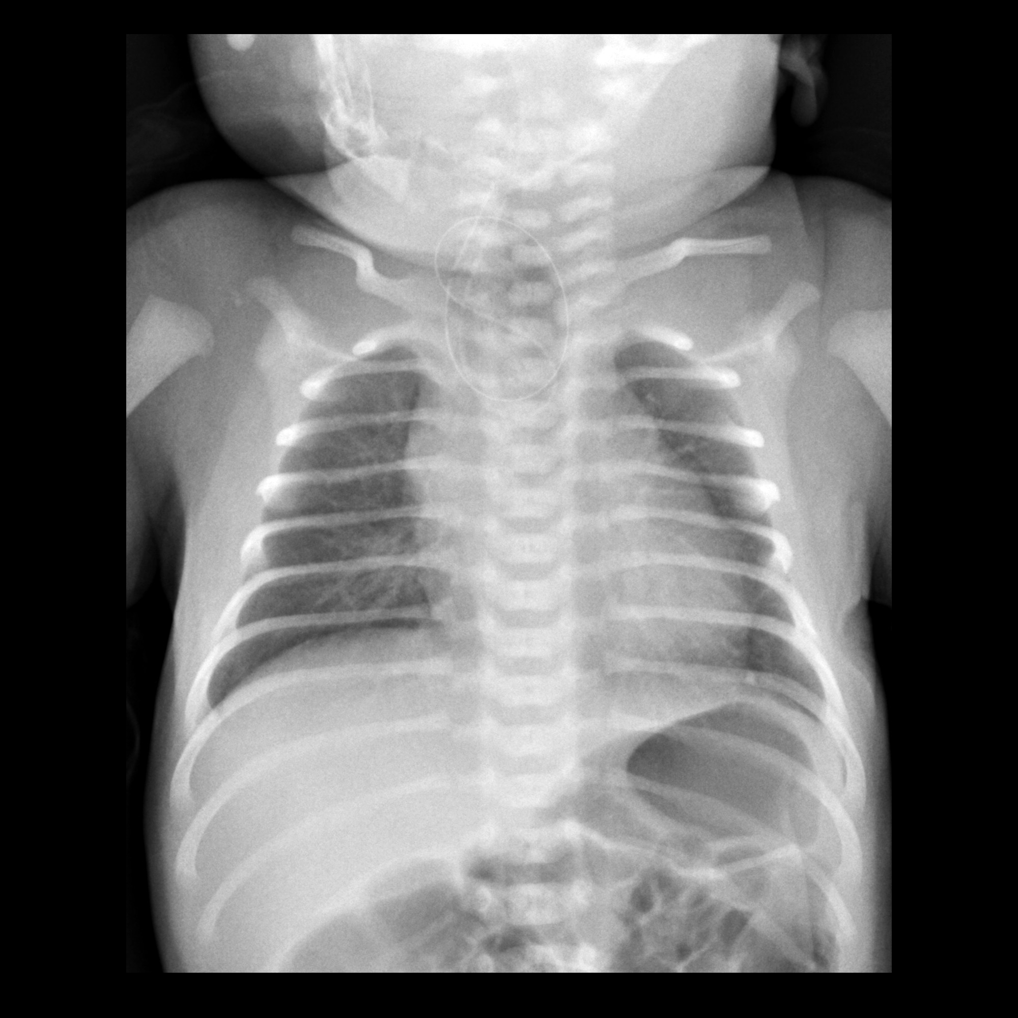 Pediatric Nasogastric Tube Malfunction / Malposition / Misposition ...