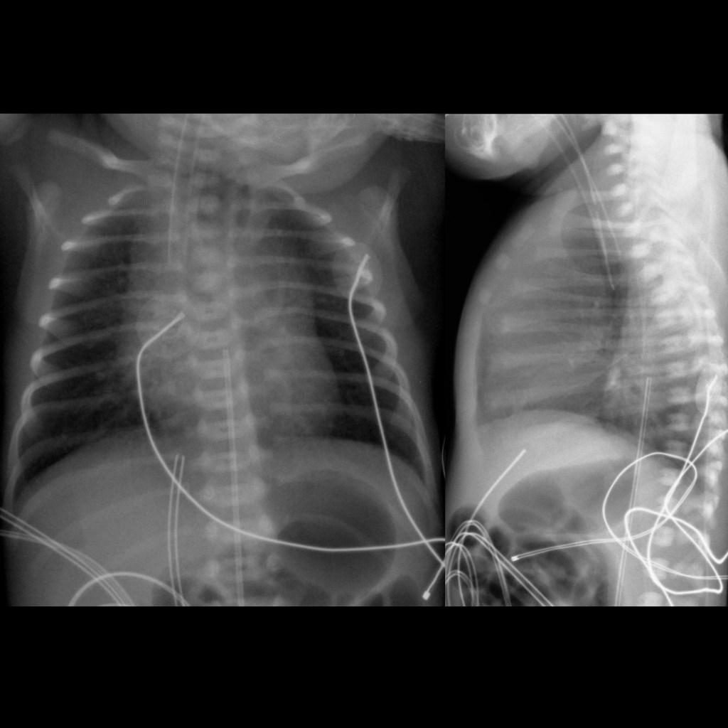 Pediatric Nasogastric Tube Malfunction / Malposition / Misposition ...
