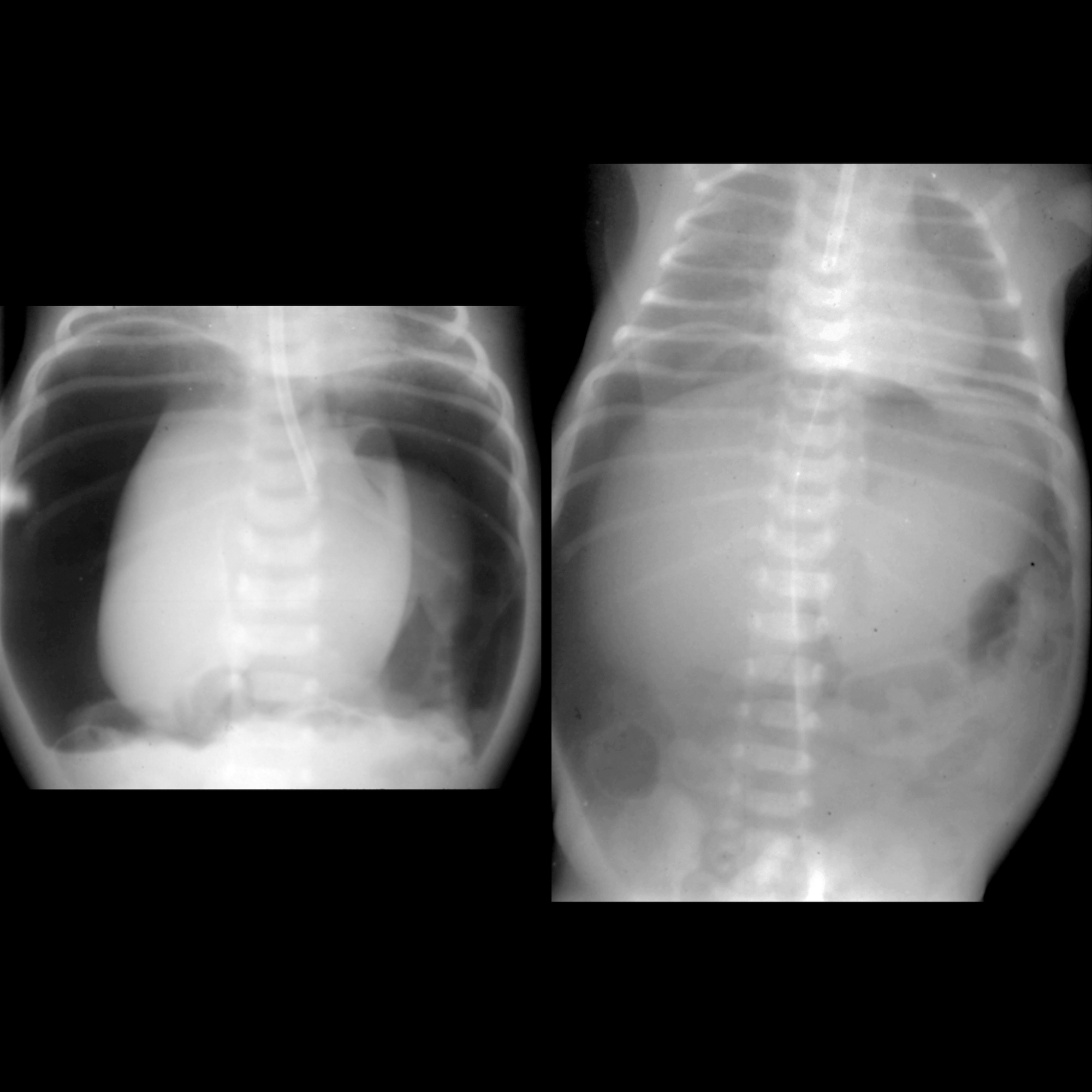 Newborn with distended abdomen after nasogastric tube placement ...