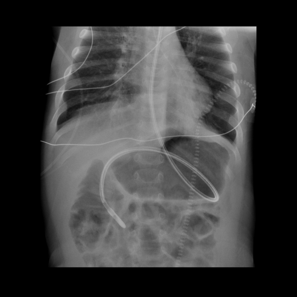 Pediatric Nasogastric Tube Malfunction / Malposition / Misposition ...