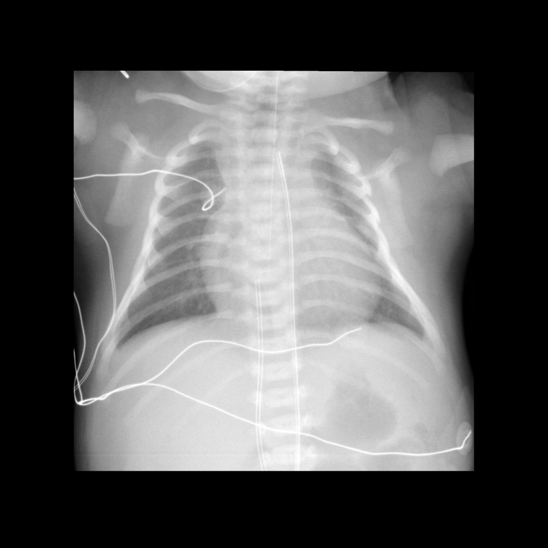 Umbilical Venous Catheter Malfunction / Malposition / Misposition ...