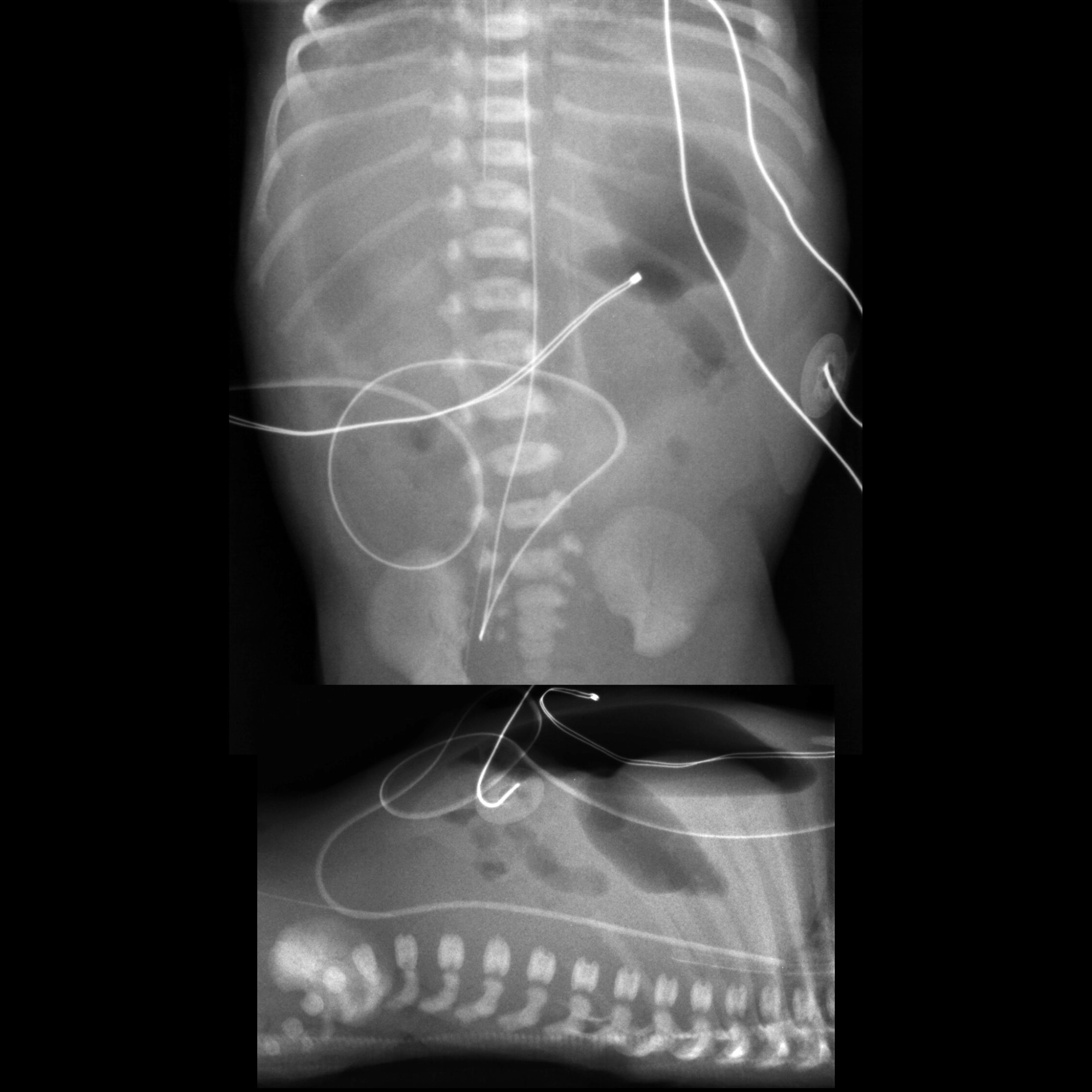 Pediatric Spontaneous Intestinal Perforation | Pediatric Radiology ...