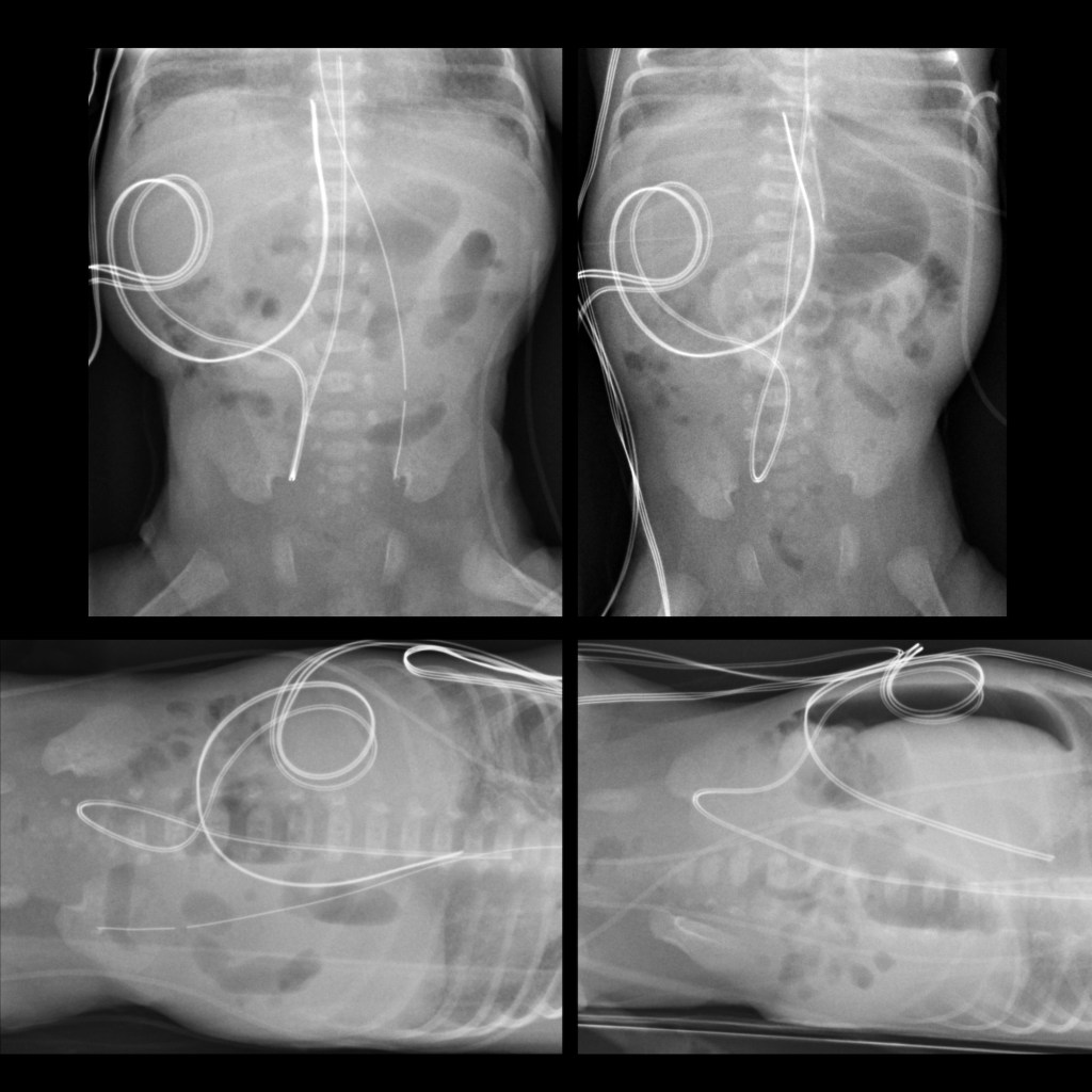Pediatric Nasogastric Tube Malfunction / Malposition / Misposition ...