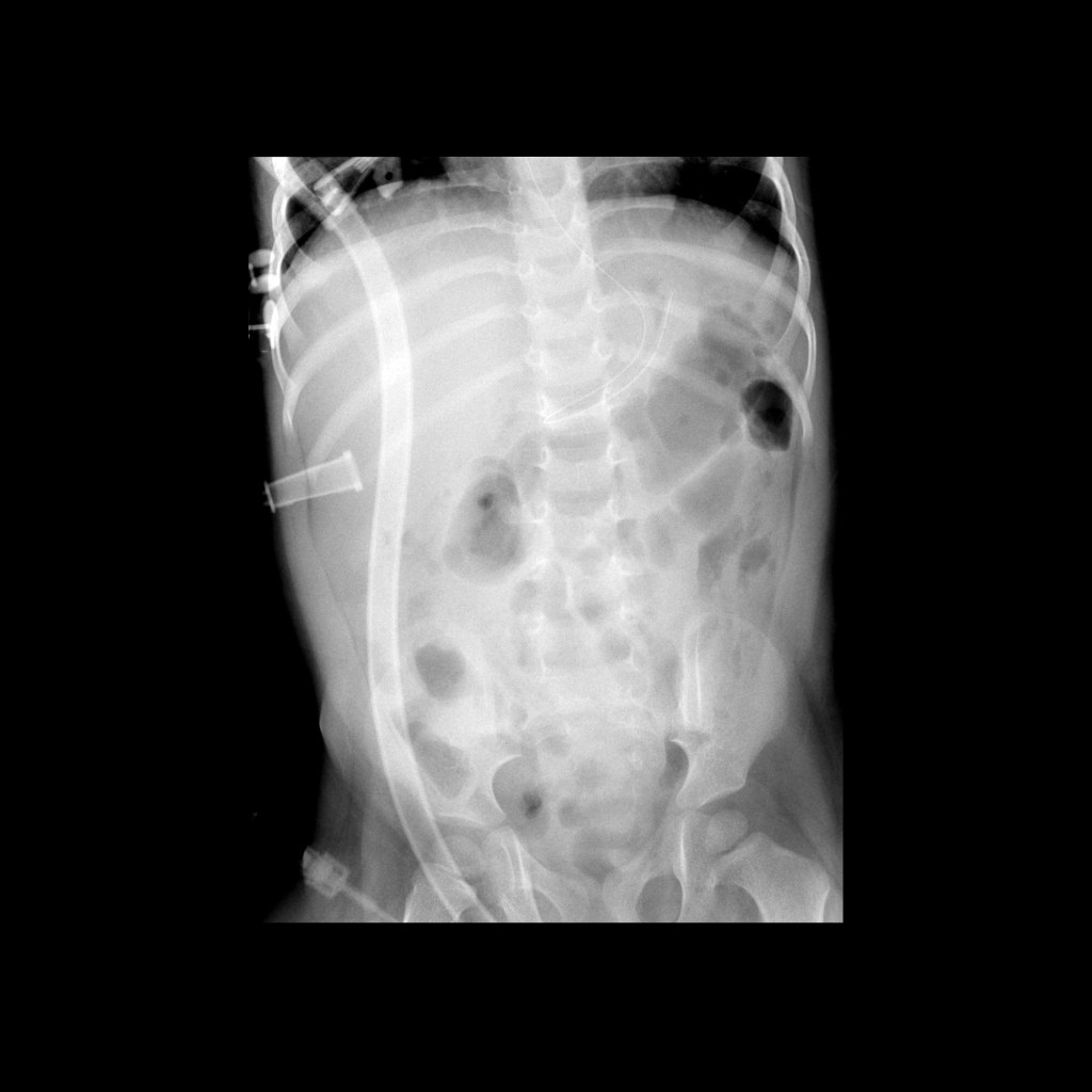 Pediatric Nasogastric Tube Malfunction / Malposition / Misposition ...