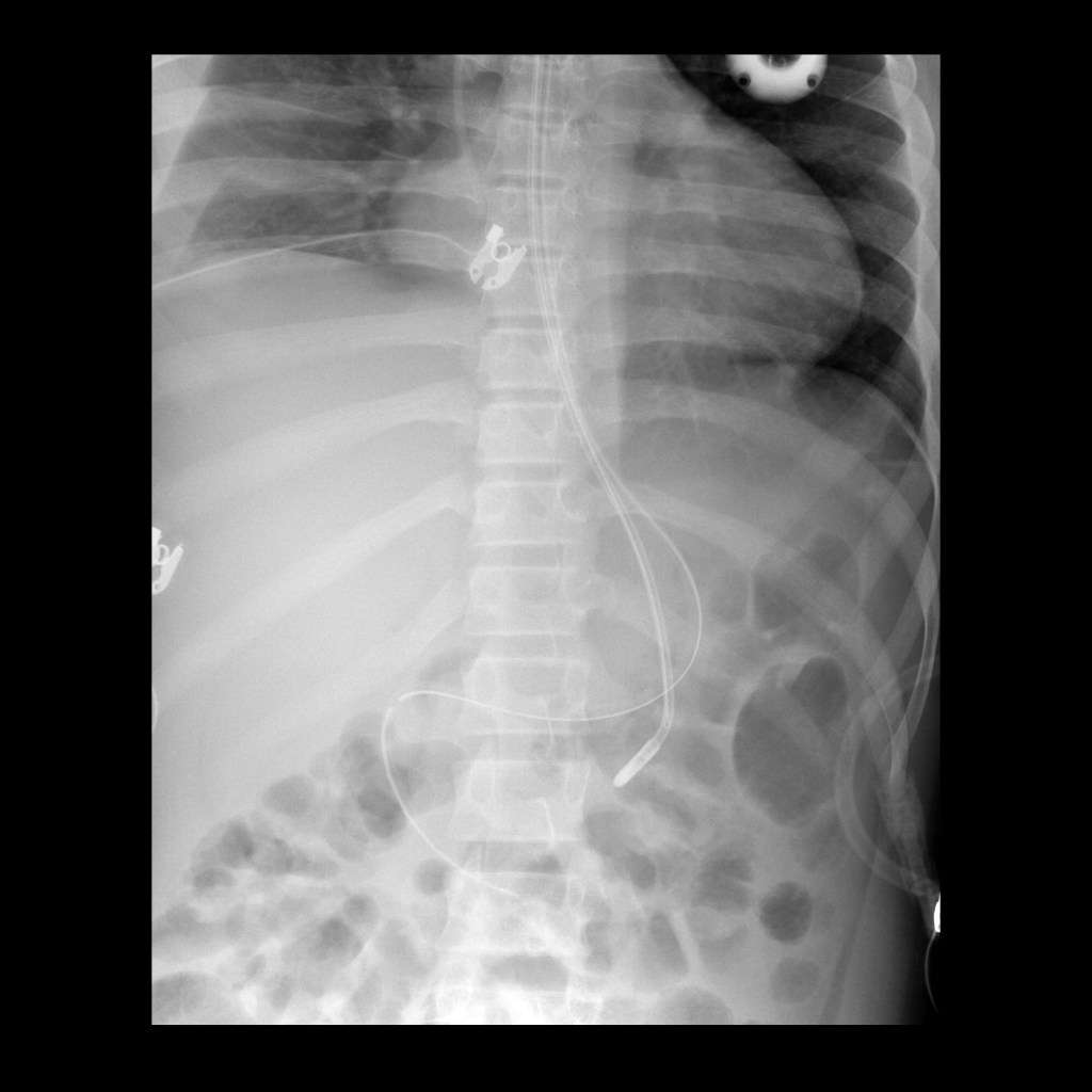 Pediatric Nasogastric Tube Malfunction / Malposition / Misposition ...